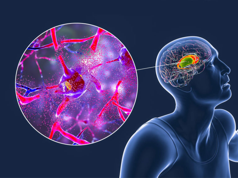 What Is Hyperkinesia?